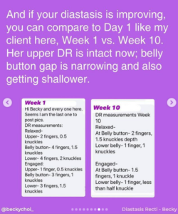 How do I determine the severity of my diastasis recti? | Becky Choi's ...